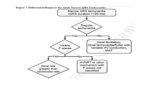 Management of svt in adult | PPTX