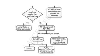 Management of svt in adult | PPTX