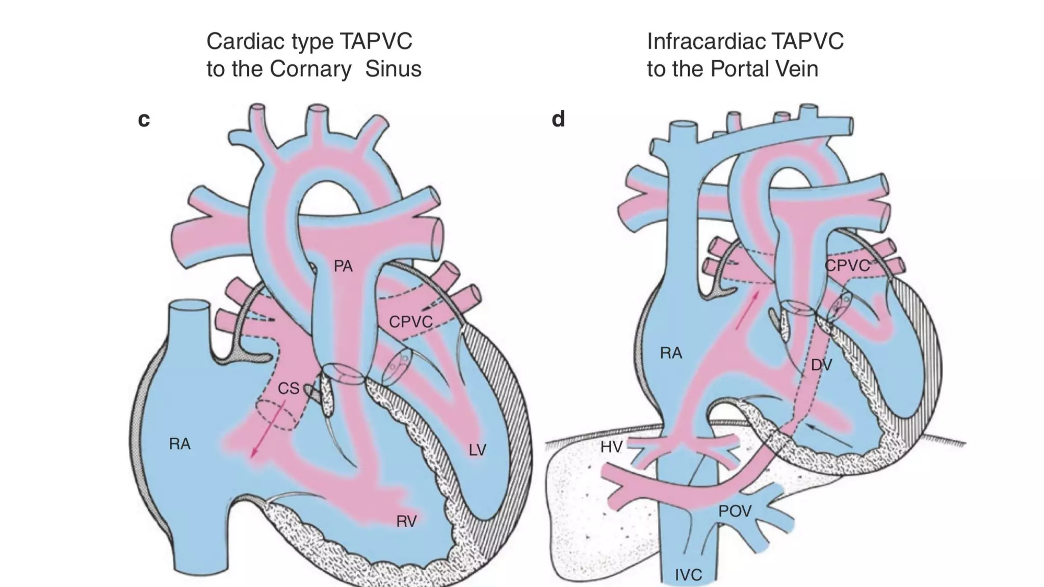 Management of tapvc | PPTX