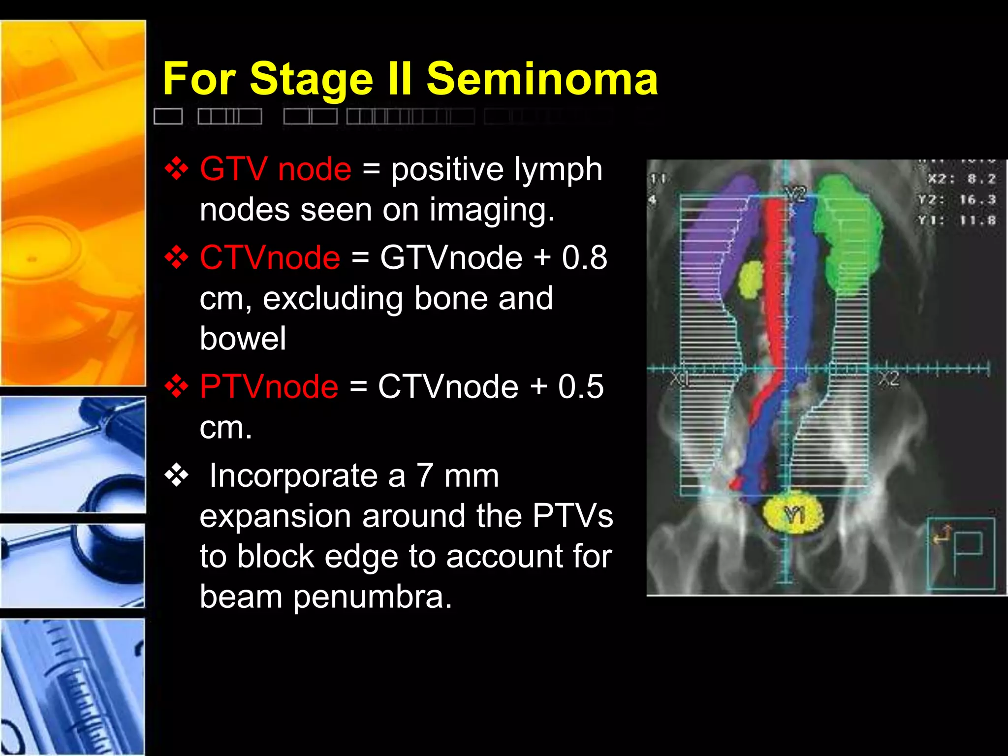 Management of testicular tumors-Seminoma (by Dr. Akhil Kapoor) | PPTX