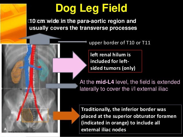 Management of testicular tumors-Seminoma (by Dr. Akhil Kapoor)