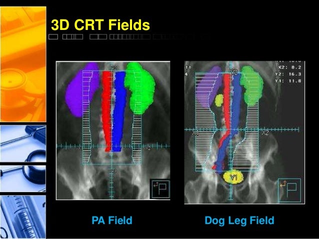 Management of testicular tumors-Seminoma (by Dr. Akhil Kapoor)