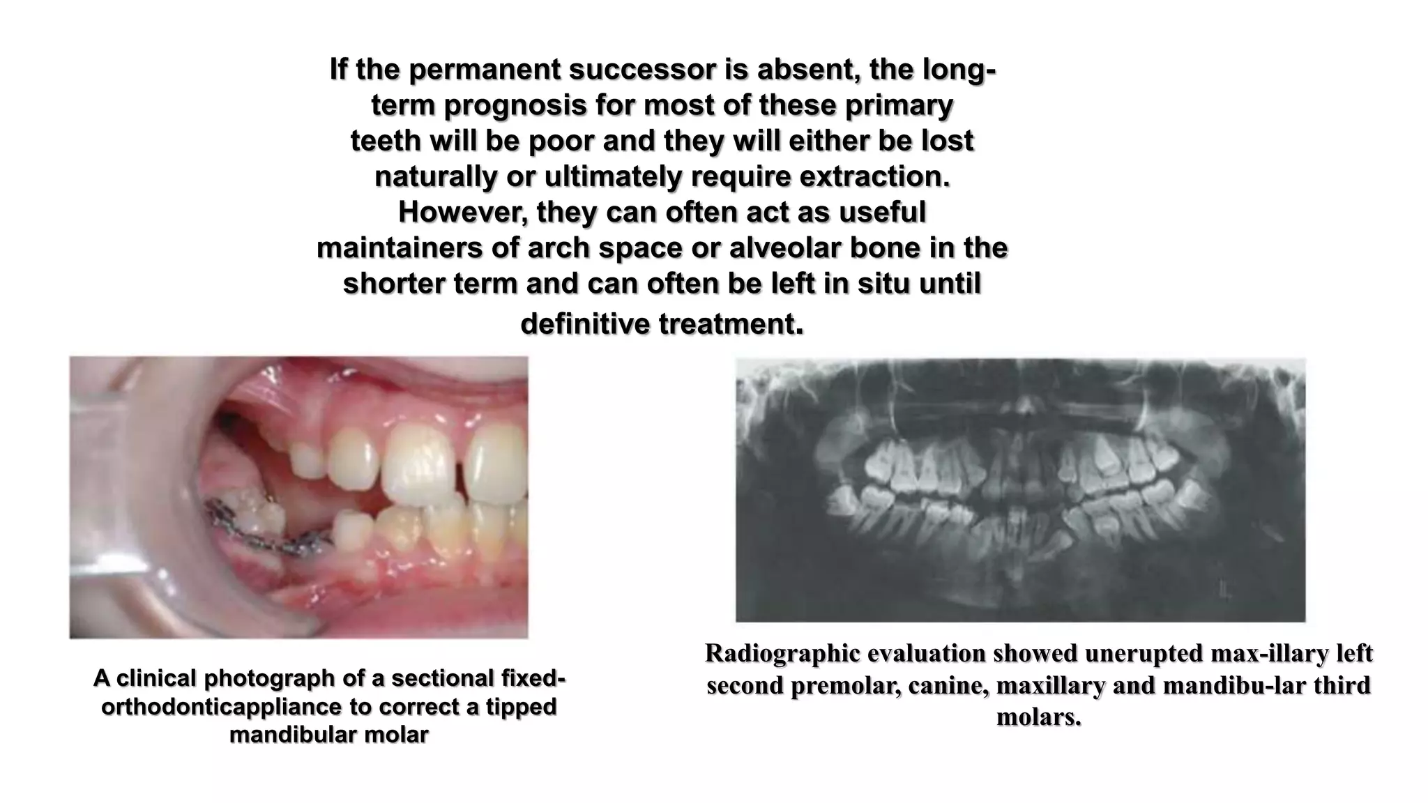 Management of the developing dentition 1 | PPTX