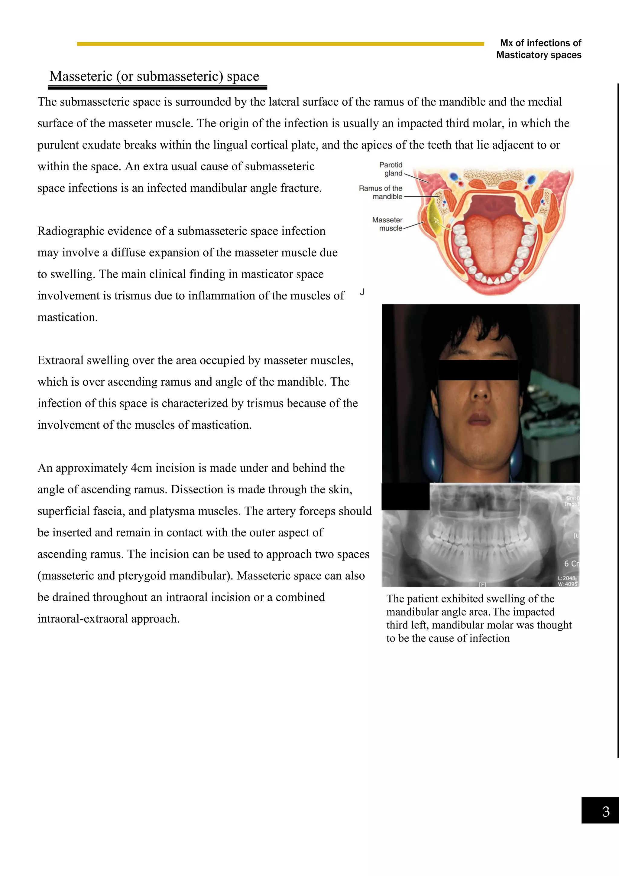 Management of the infections of the masticatory spaces | PDF