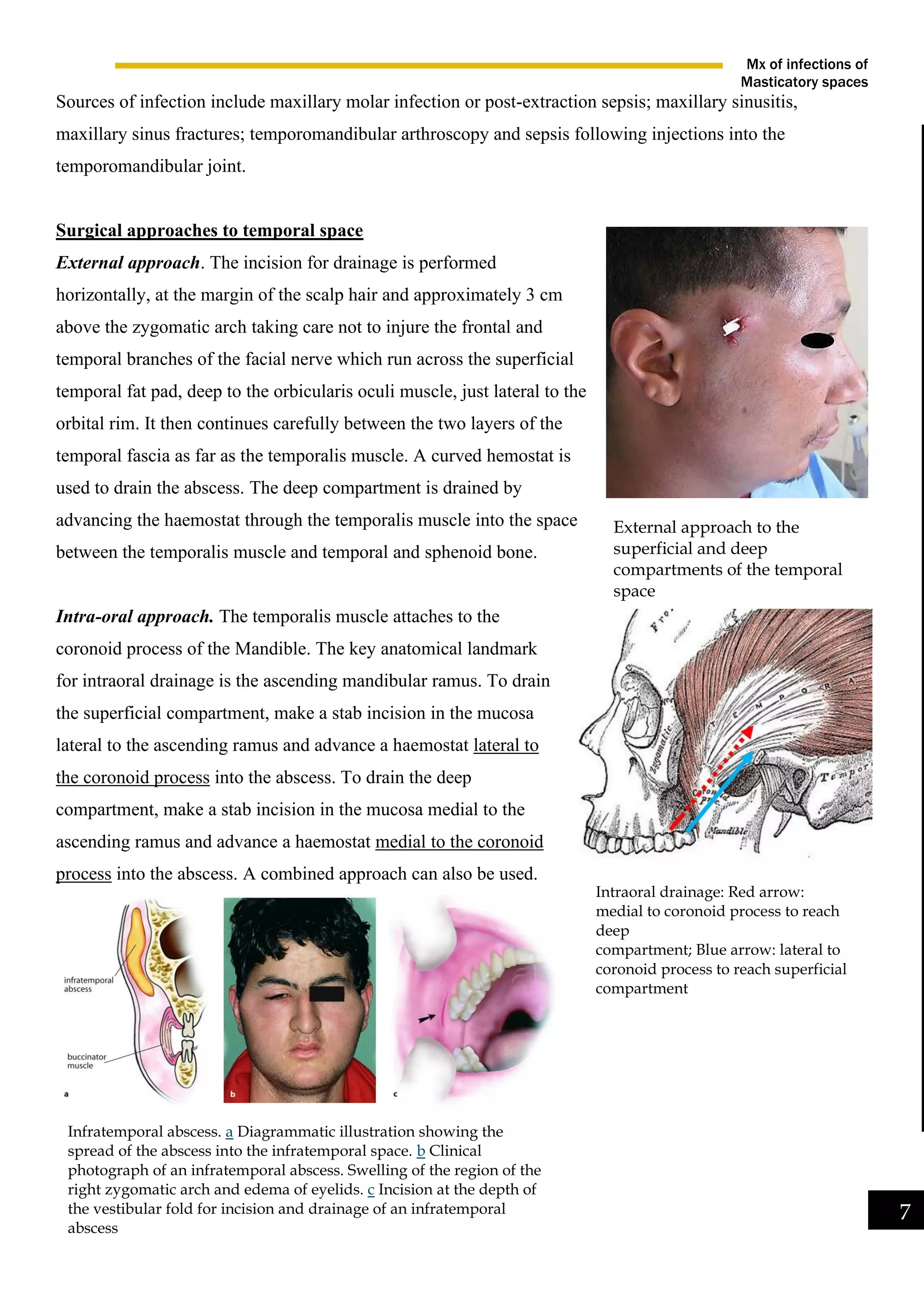 Management of the infections of the masticatory spaces | PDF