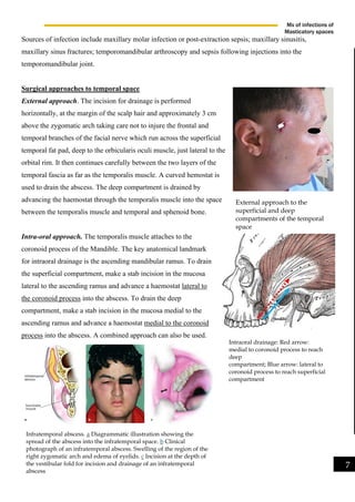 Management of the infections of the masticatory spaces | PDF
