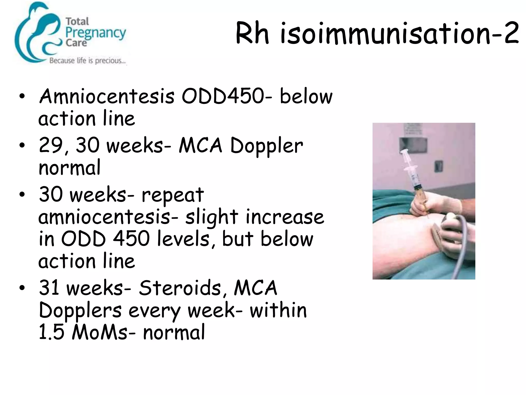 Management of the Rhesus Negative Mother | PPTX
