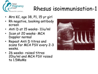 Management of the Rhesus Negative Mother | PPTX