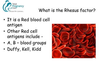 Management of the Rhesus Negative Mother | PPTX