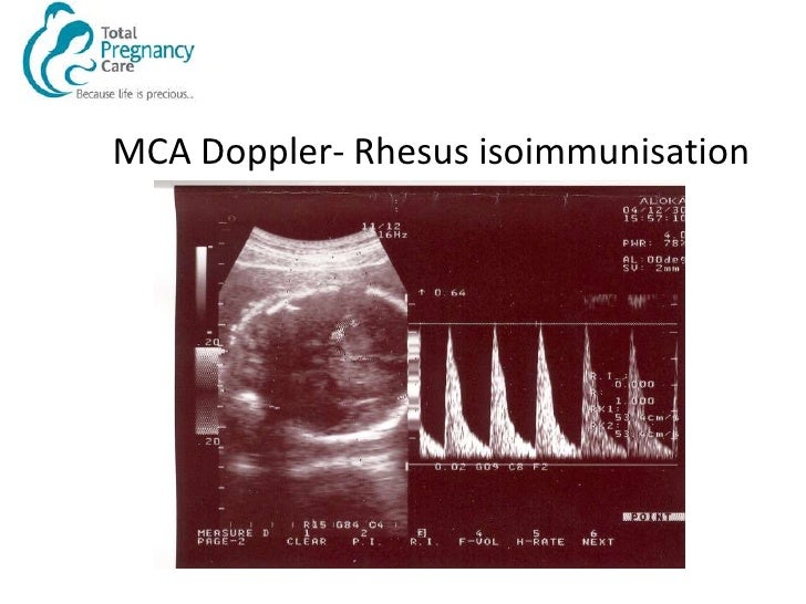 Management of the Rhesus Negative Mother