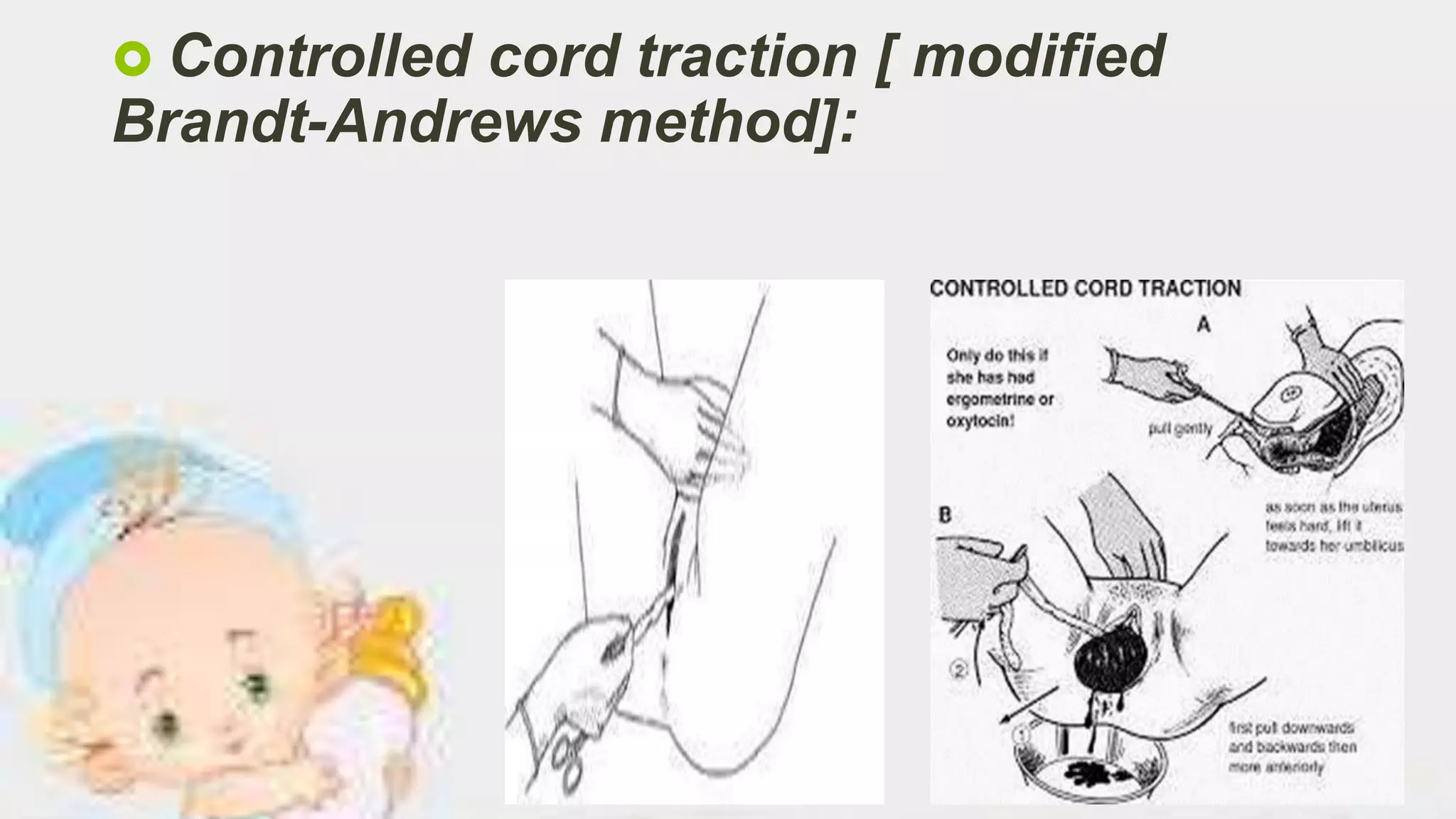 Management of third stage of labour | PPTX
