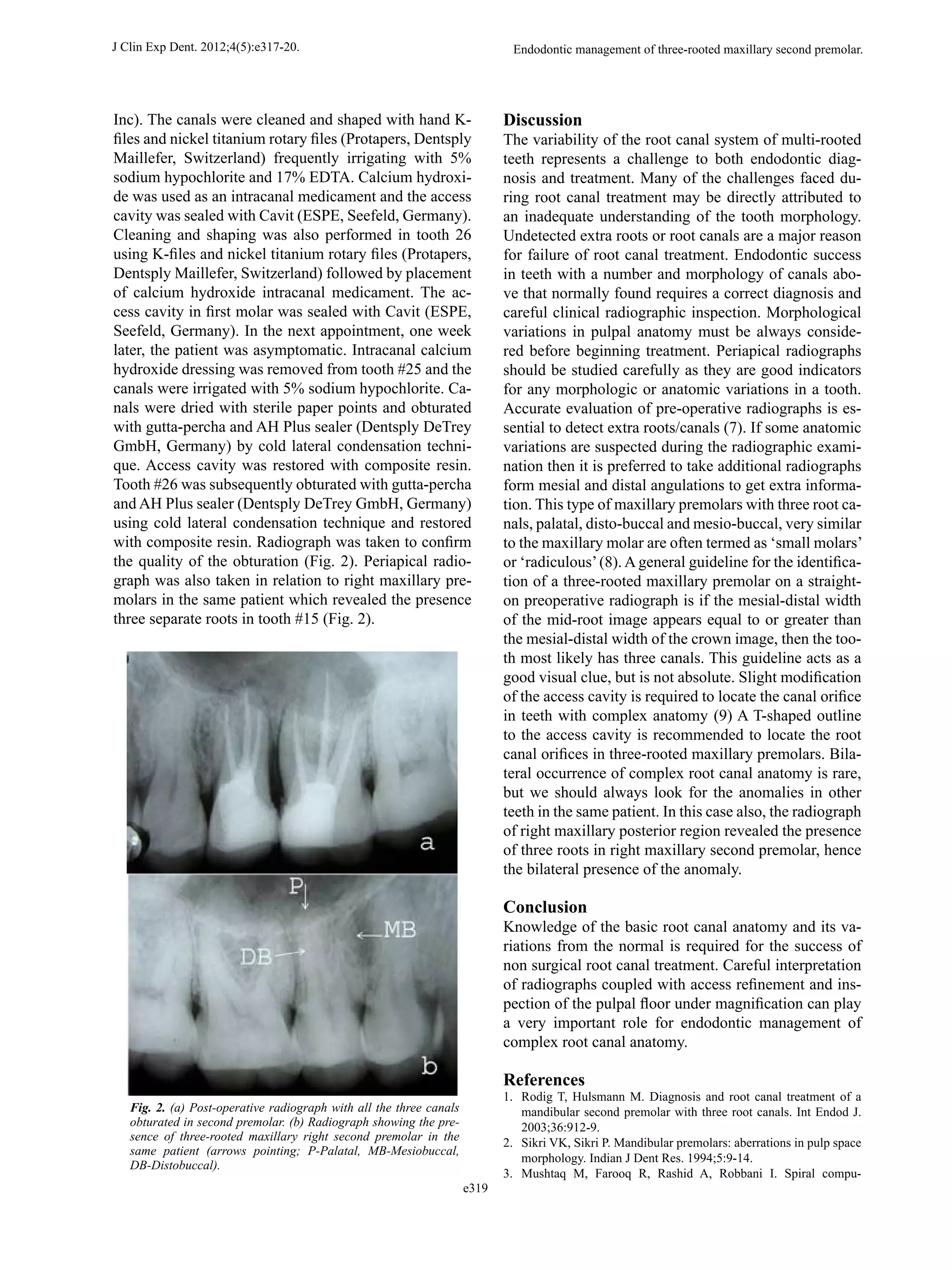 Management of three rooted maxillary second premolar | PDF