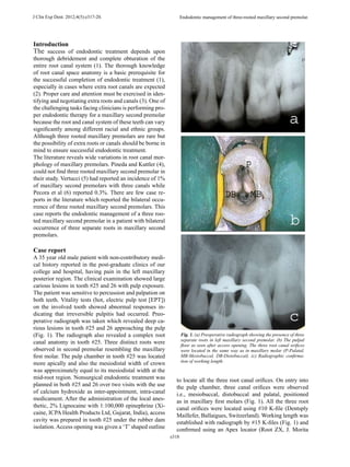 Management of three rooted maxillary second premolar | PDF