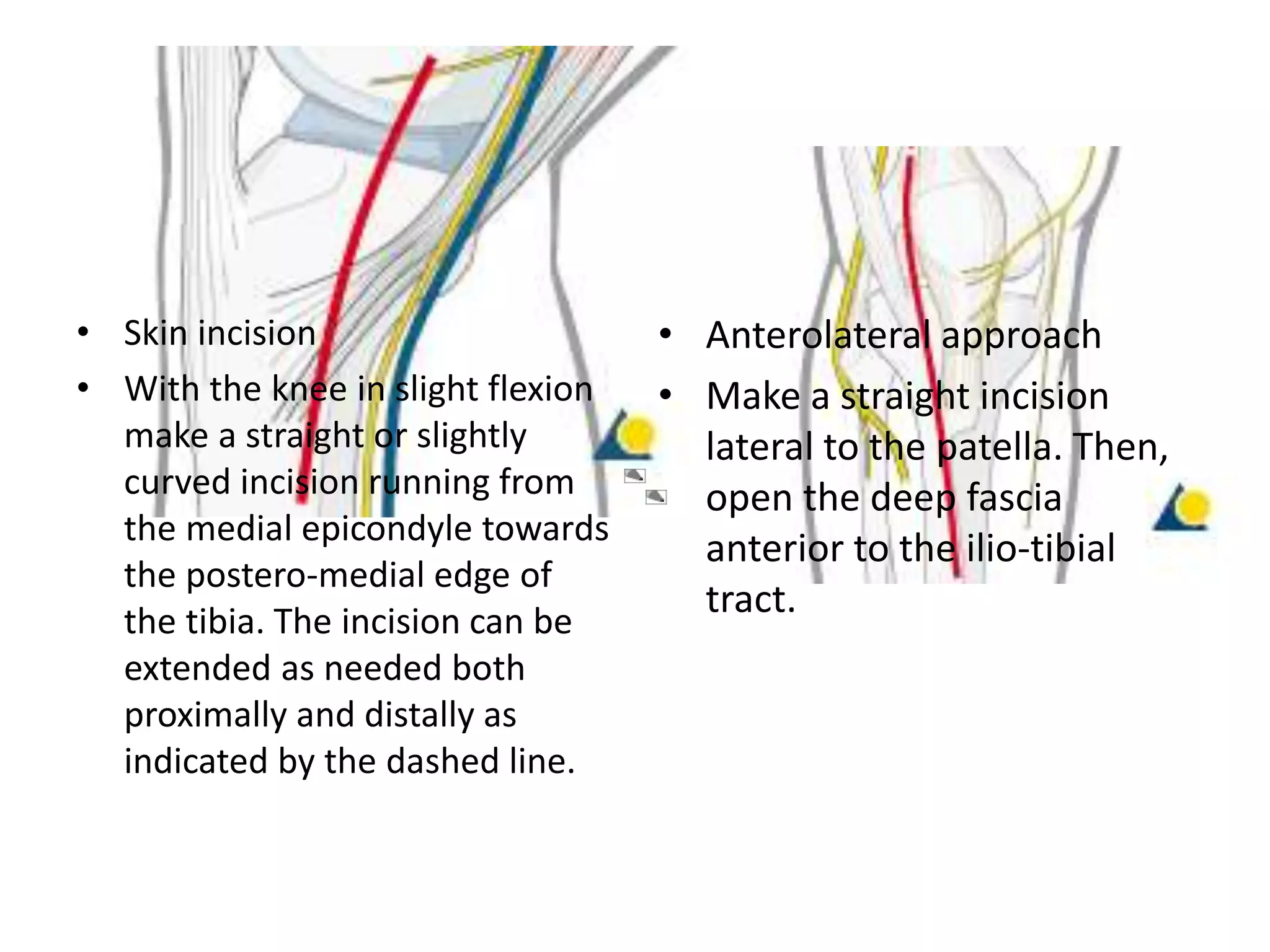 Management of tibial plateau fracture | PPTX