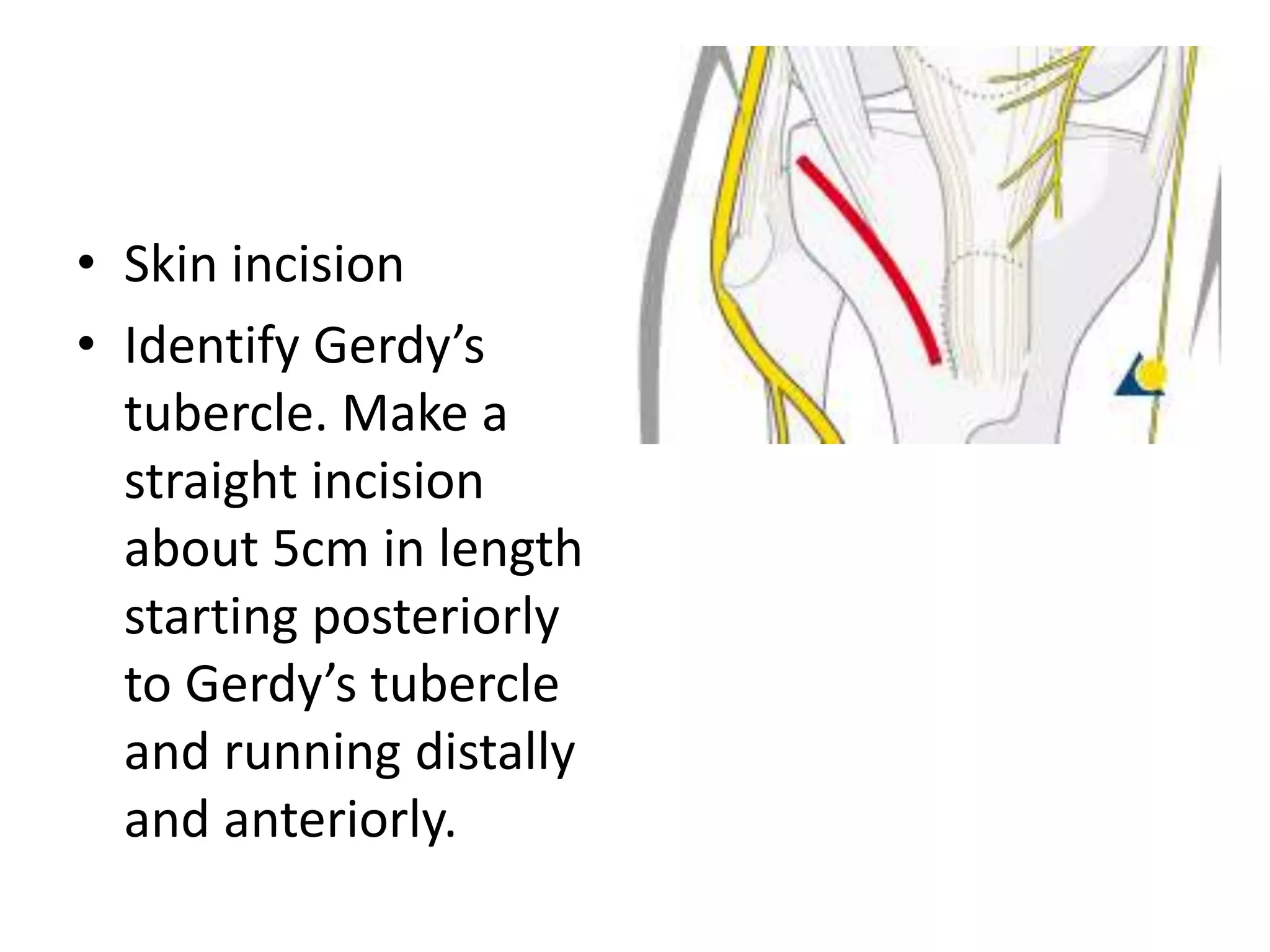 Management of tibial plateau fracture | PPTX