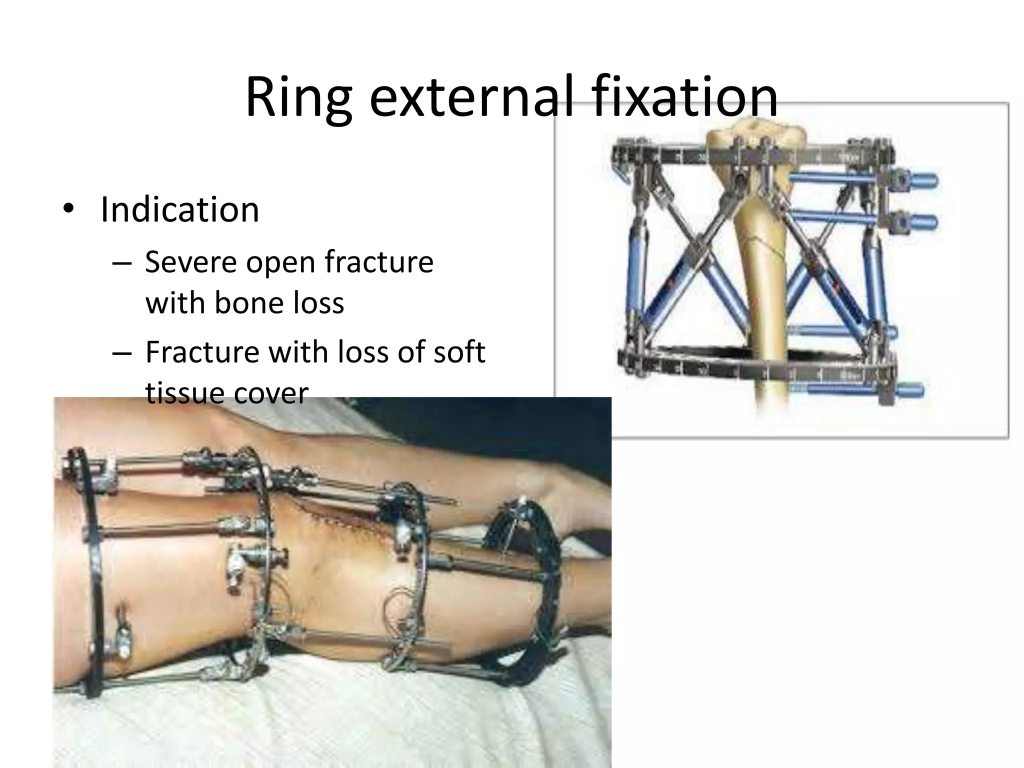 Management of tibial plateau fracture | PPTX