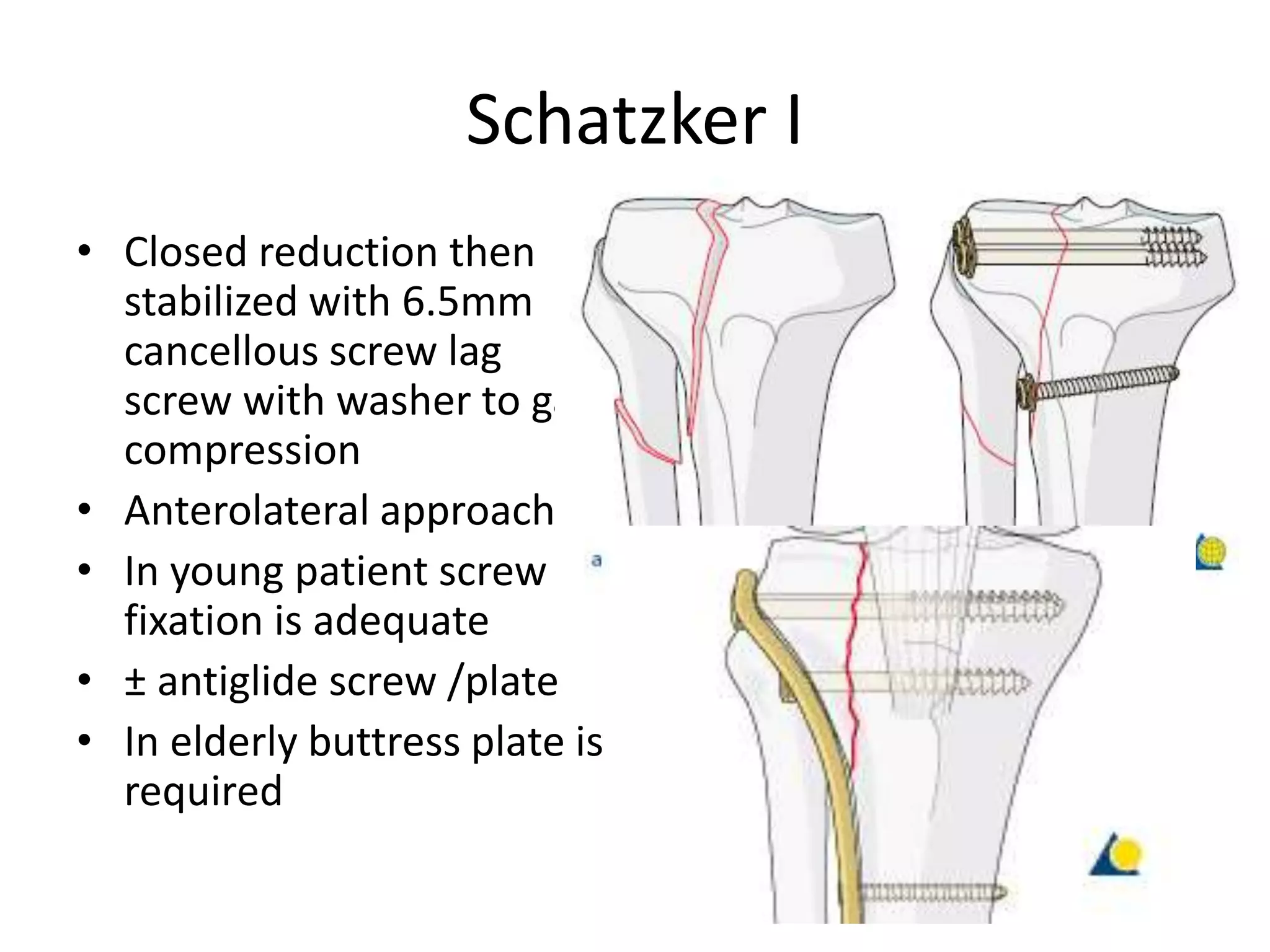 Management of tibial plateau fracture | PPTX