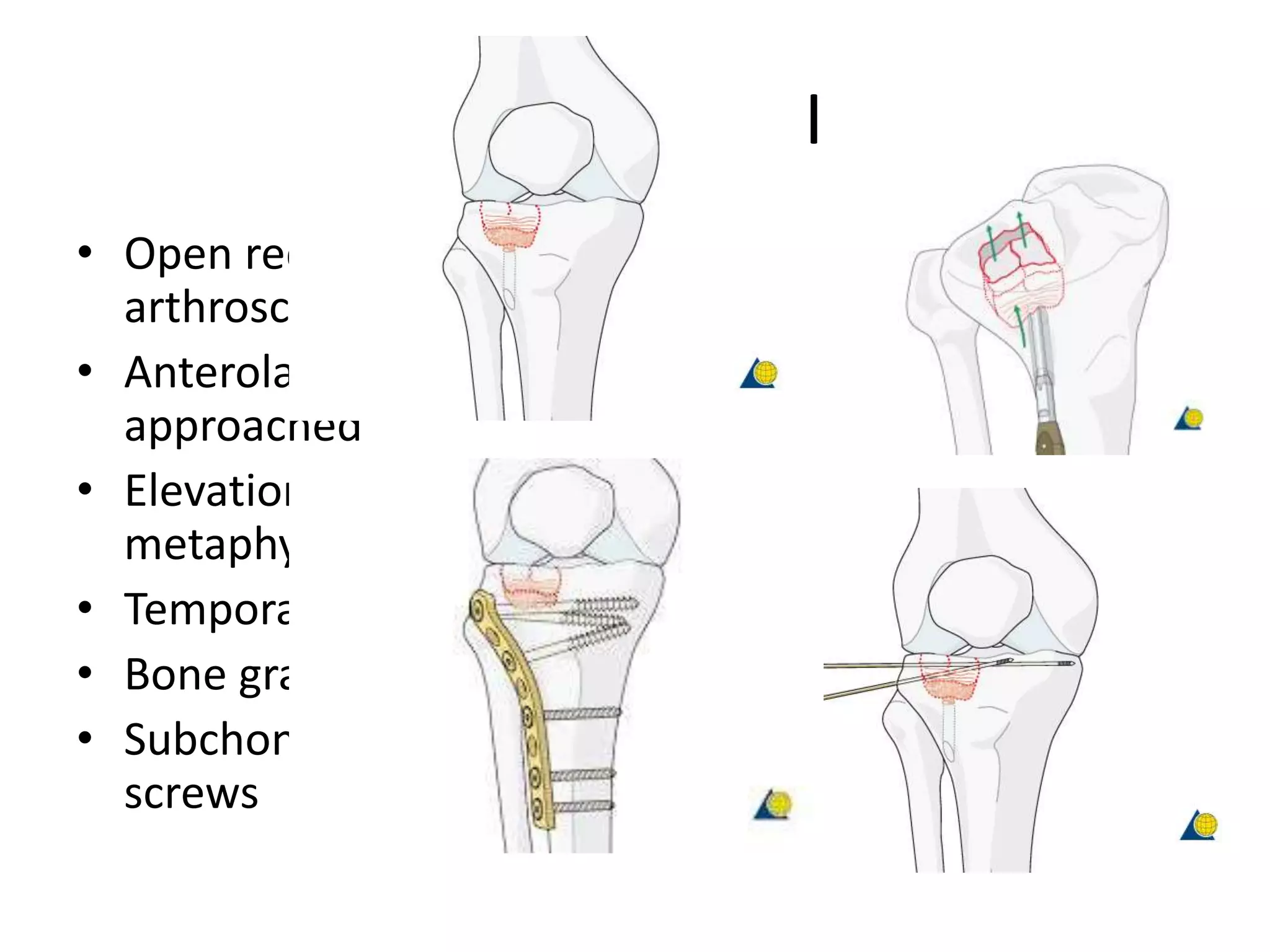 Management of tibial plateau fracture | PPTX