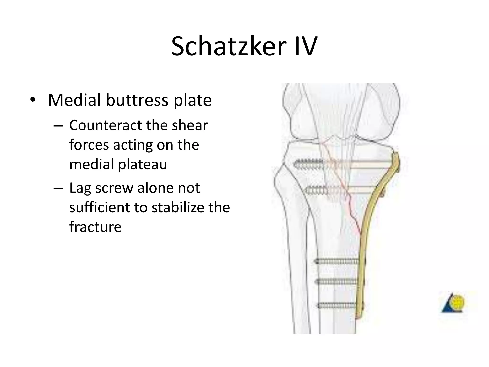 Management of tibial plateau fracture | PPTX