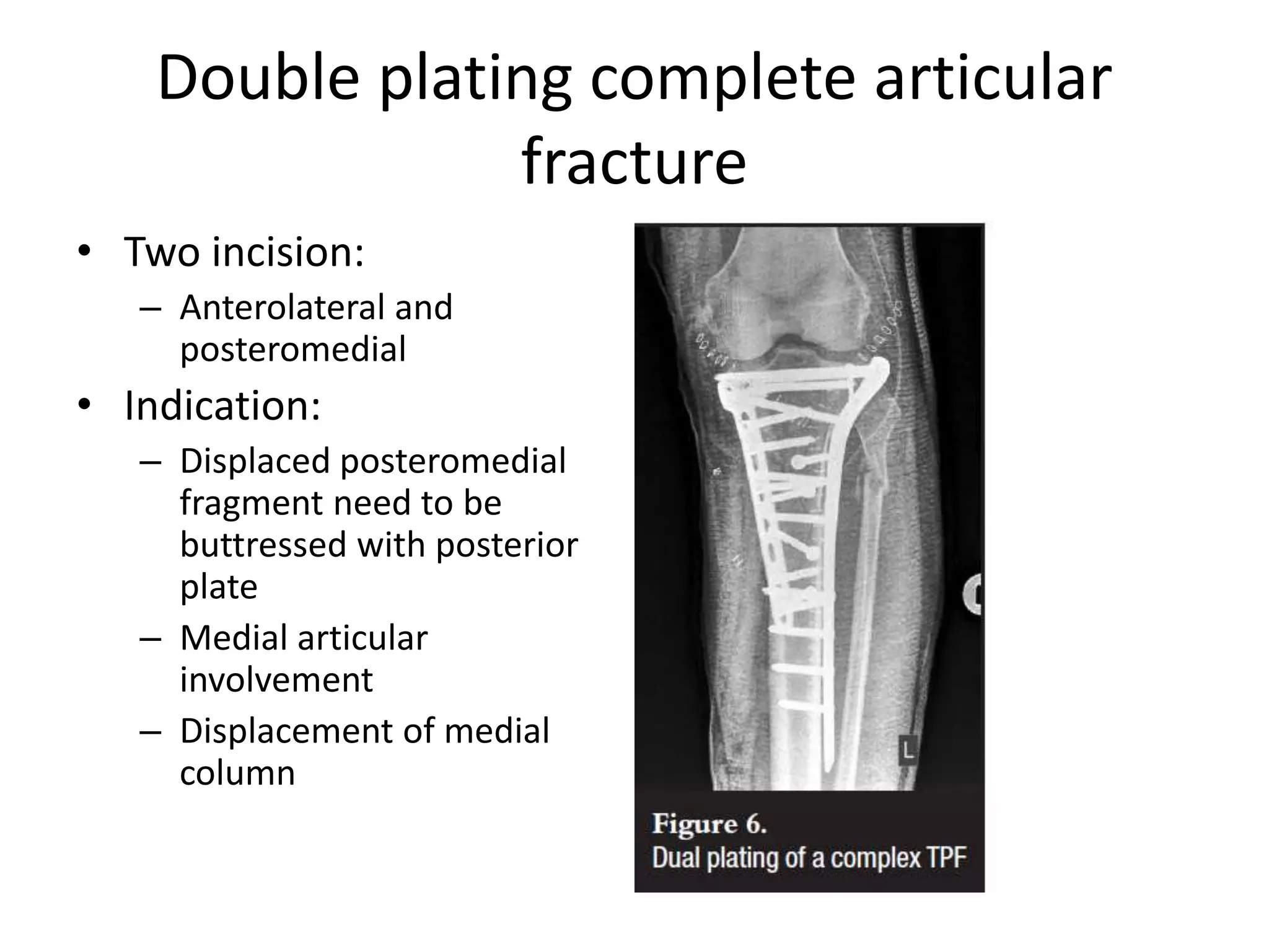 Management of tibial plateau fracture | PPTX