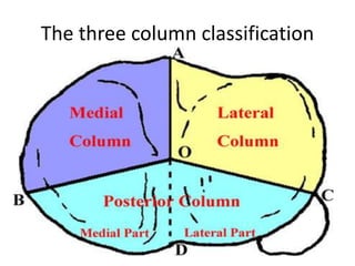 Management of tibial plateau fracture | PPTX