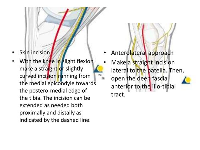 Management of tibial plateau fracture | PPTX