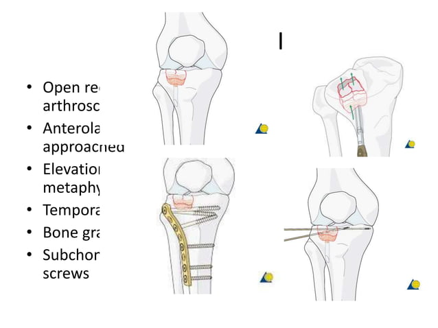 Management of tibial plateau fracture | PPTX