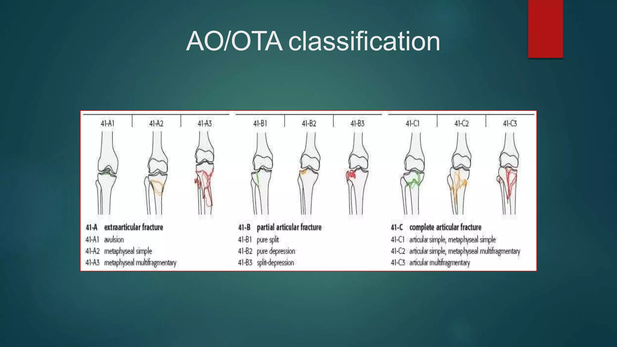 Management of tibial plateau fracture | PPTX