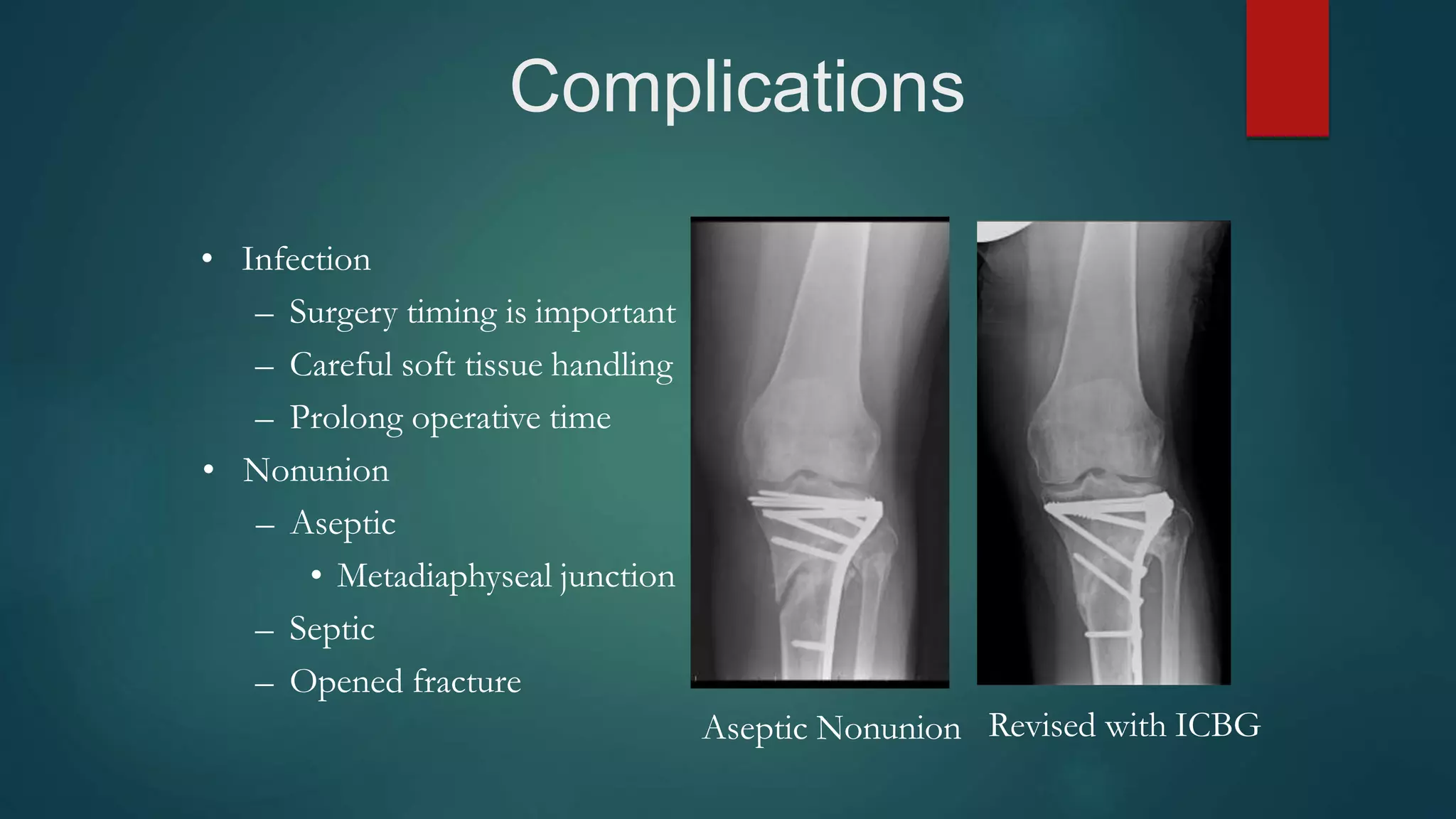 Management of tibial plateau fracture | PPTX
