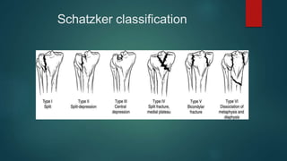 Management of tibial plateau fracture | PPTX