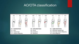 Management of tibial plateau fracture | PPTX