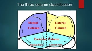Management of tibial plateau fracture | PPTX