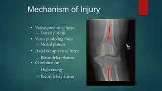 Management of tibial plateau fracture | PPTX