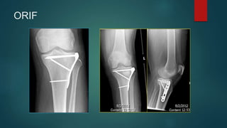 Tibial Plateau Fracture Orif