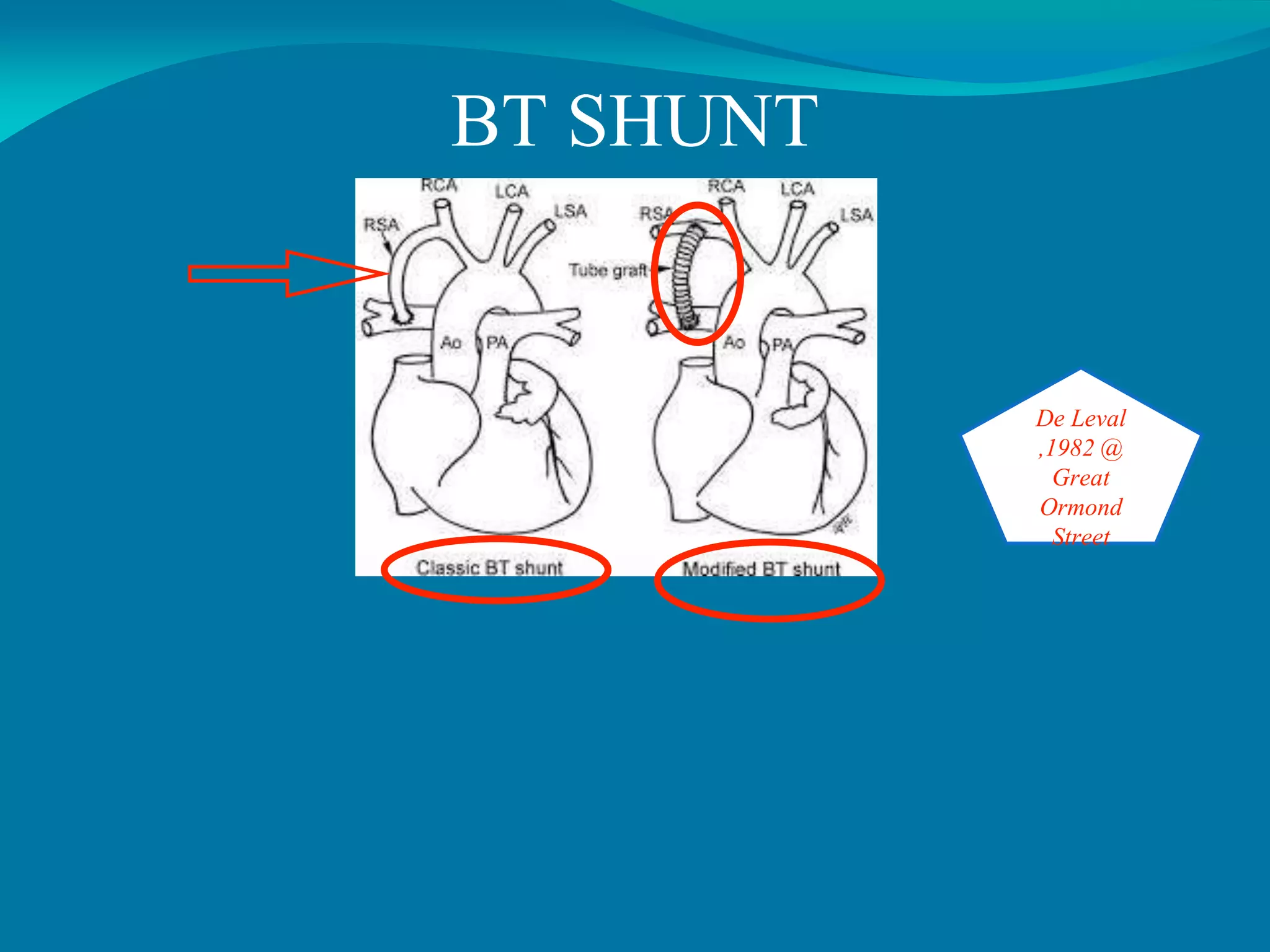Management of Tetralogy of Fallot | PPTX