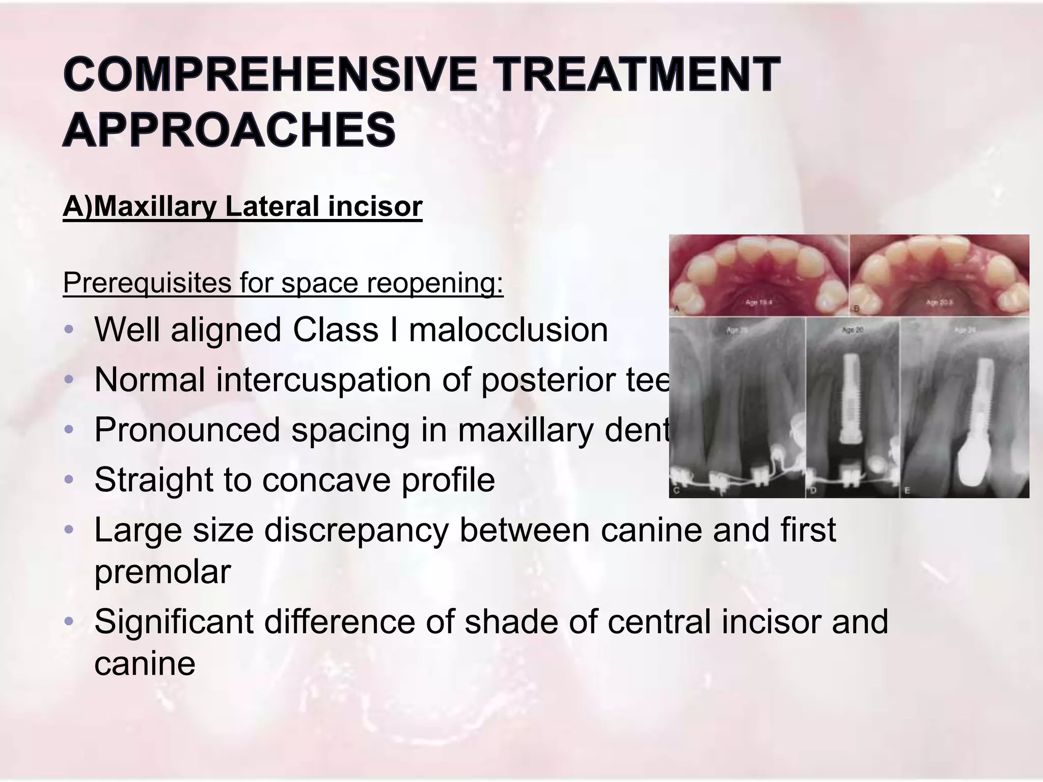 Management of tooth agenesis in orthodontics | PPTX