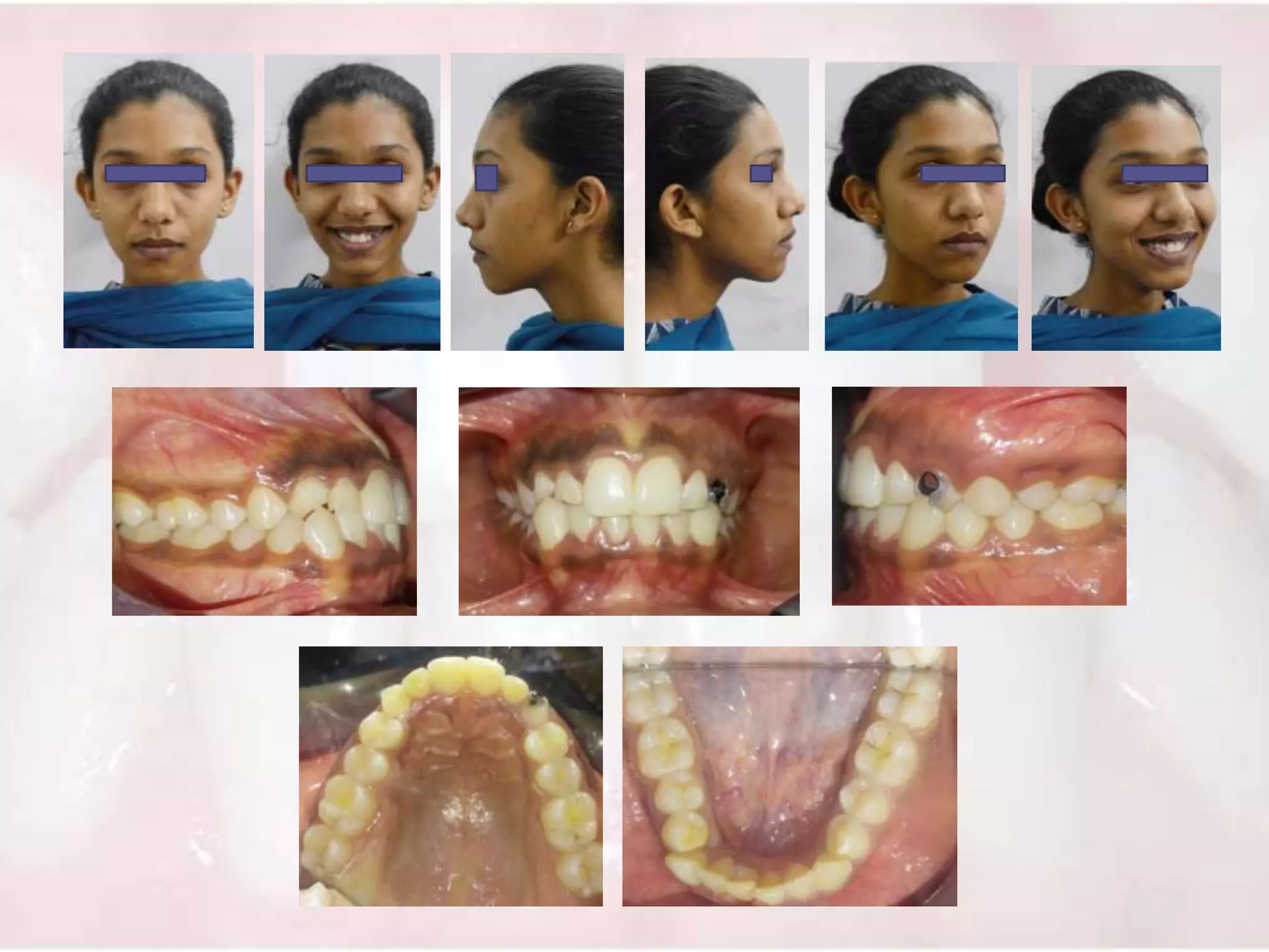 Management of tooth agenesis in orthodontics | PPTX