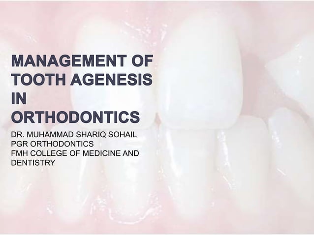 Management of tooth agenesis in orthodontics | PPTX | Dental Health ...