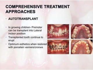Management of tooth agenesis in orthodontics | PPTX