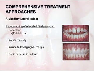 Management of tooth agenesis in orthodontics | PPTX
