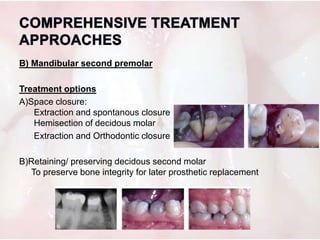 Management of tooth agenesis in orthodontics | PPTX