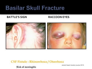 Basilar Skull Fracture Raccoon Eyes