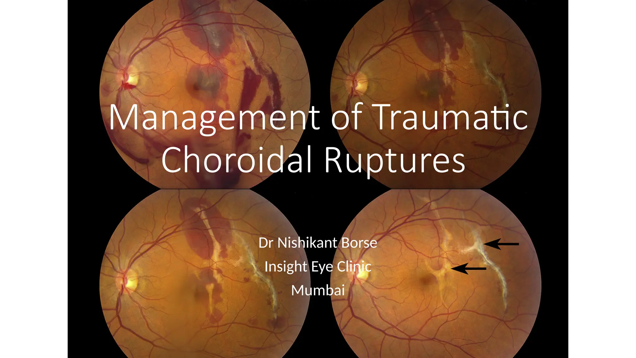 Management of Traumatic Choroidal Ruptures.pptx