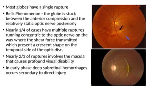 Management of Traumatic Choroidal Ruptures.pptx