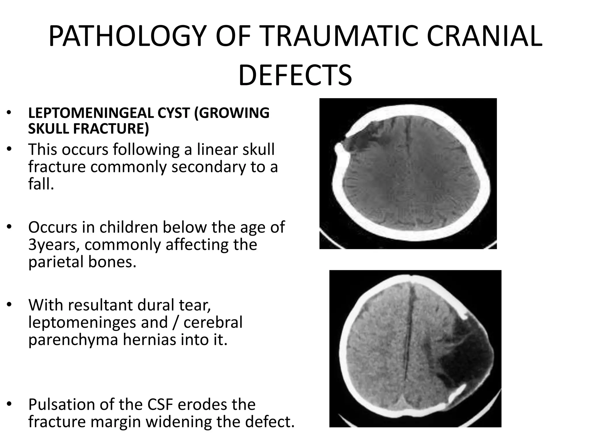 Management of traumatic cranial defect (PATHOLOGY) | PPTX