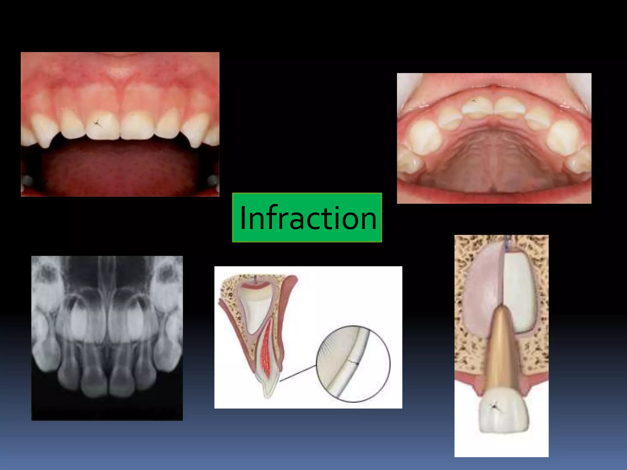 Management of traumatic dental injury of primary teeth | PPTX