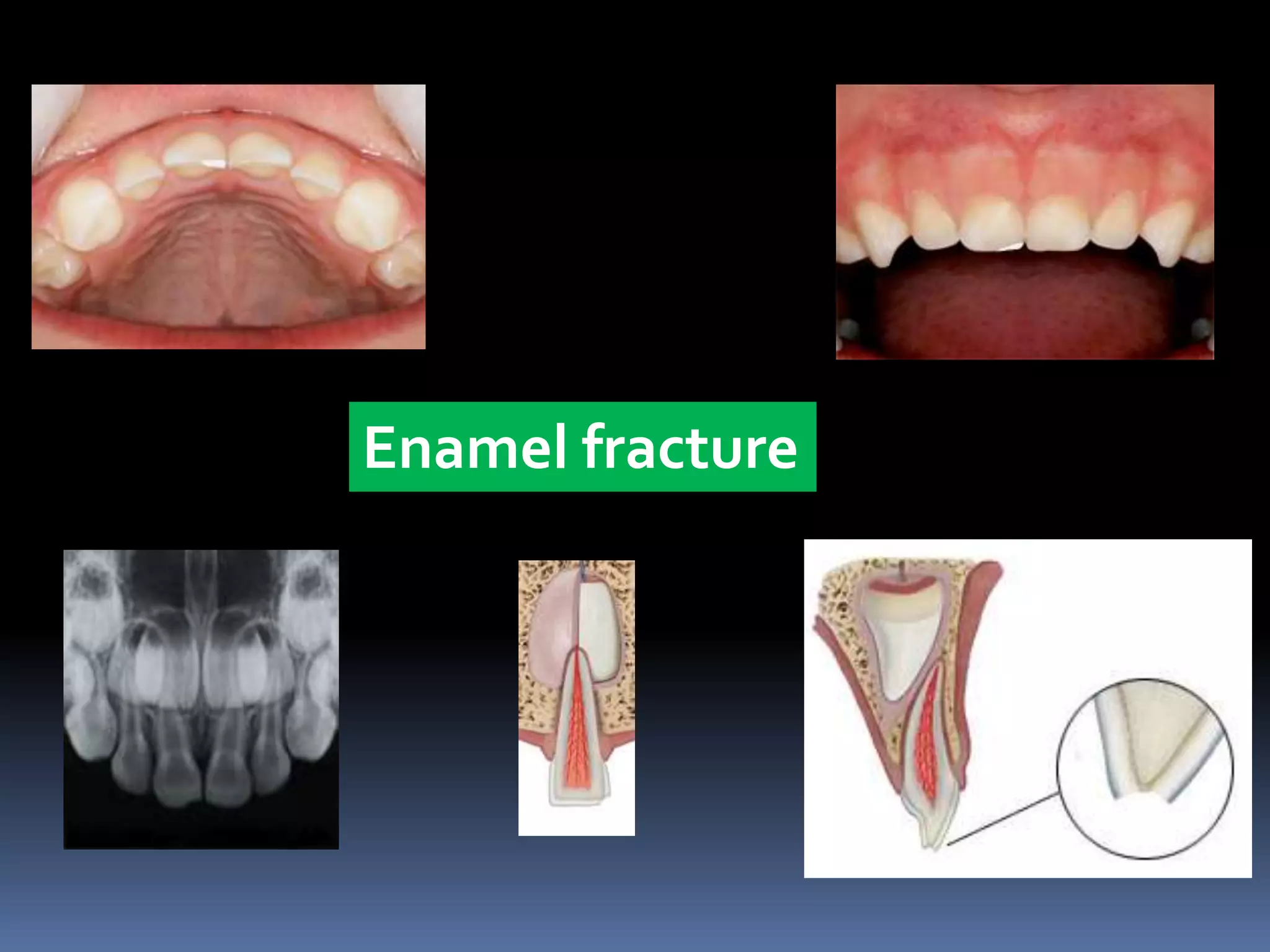 Management of traumatic dental injury of primary teeth | PPTX
