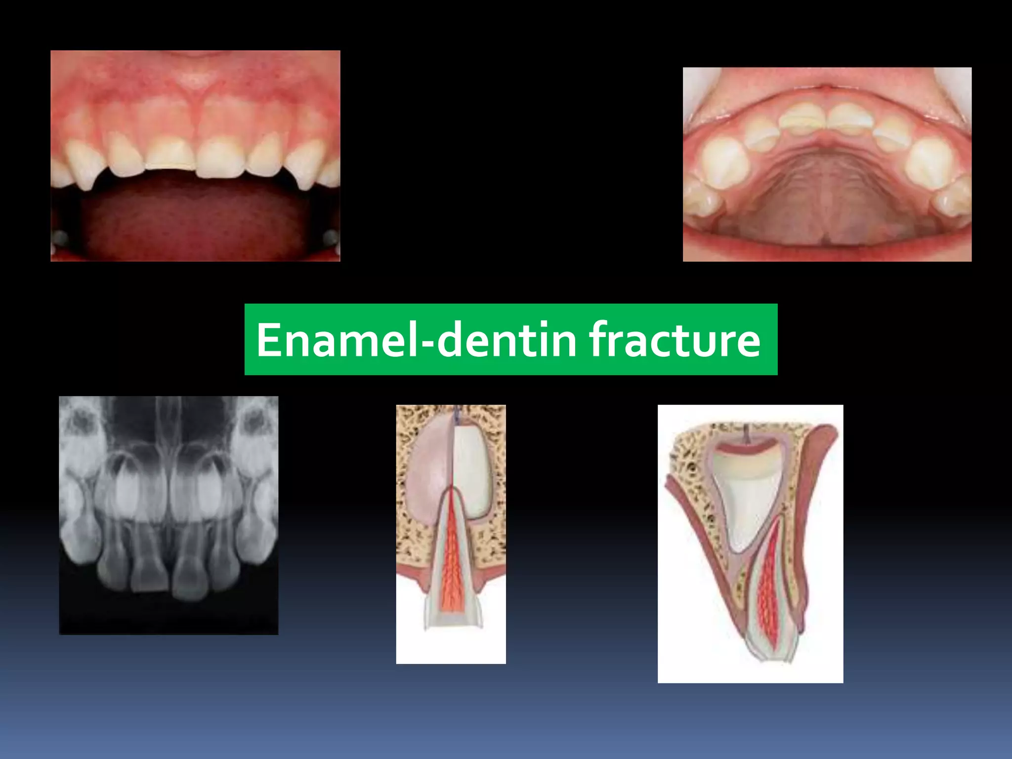 Management of traumatic dental injury of primary teeth | PPTX
