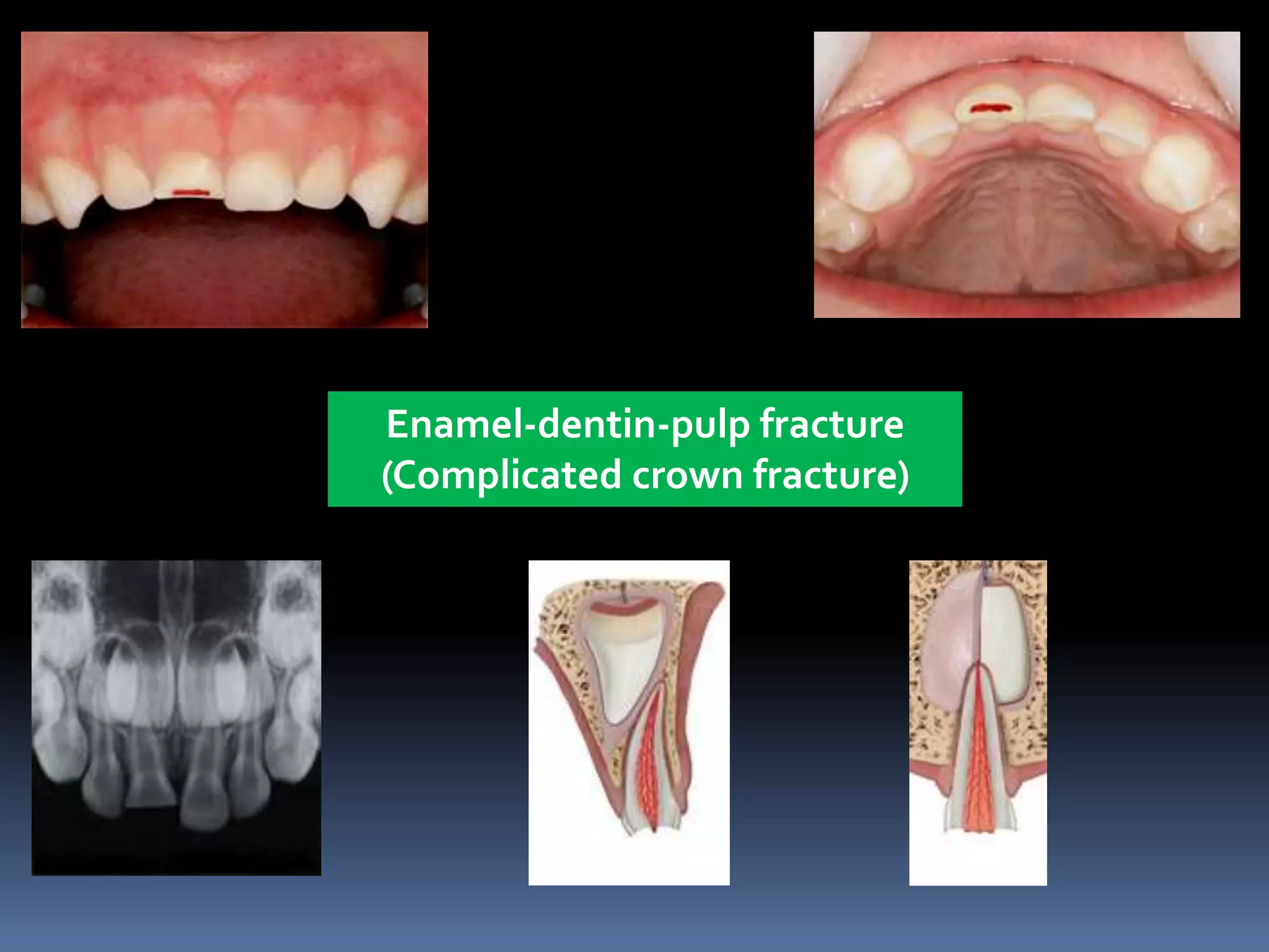 Management of traumatic dental injury of primary teeth | PPTX