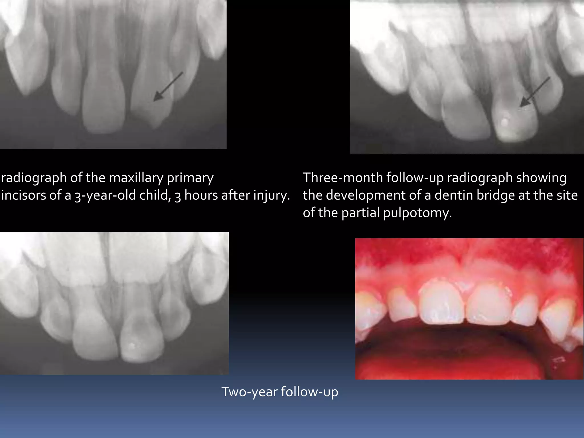 Management of traumatic dental injury of primary teeth | PPTX